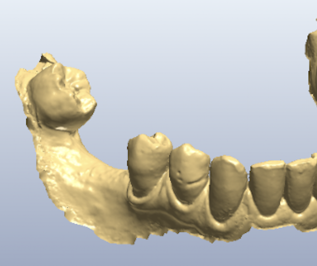 Xflow AI - Automatic Bracket Removal Edge Cases - Dental Axess